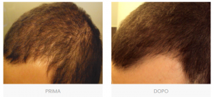 PRP capelli: come funziona il trattamento che li fa ricrescere? | OK Salute